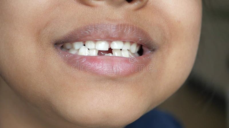 Detail Shot of Child with Teeth Missing Stock Footage - Video of oral ...