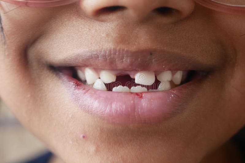 Detail Shot of Child with Teeth Missing Stock Image - Image of oral ...