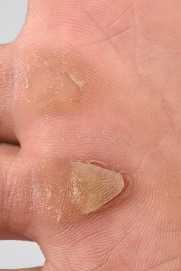 Calluses Op De Palm En De Vingers Van De Hand Arbeidskorrels Stock ...