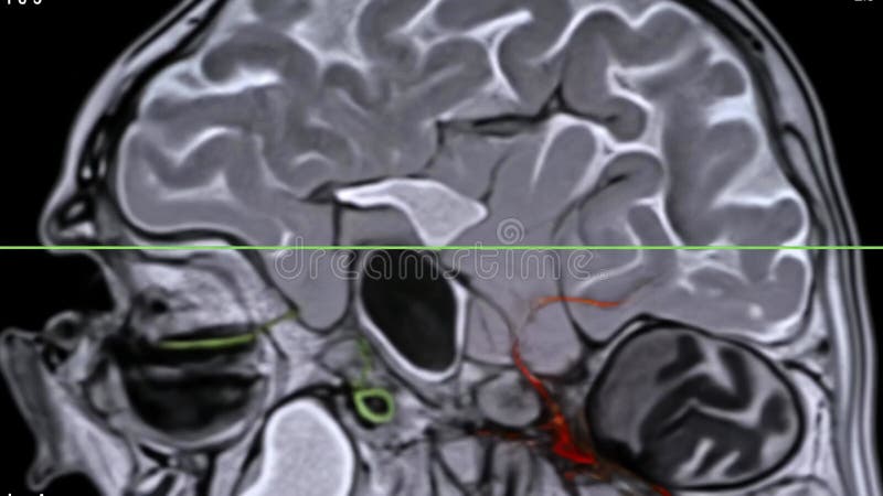 Exploring Brain Anatomy through Detailed MRI Imaging in a Medical ...