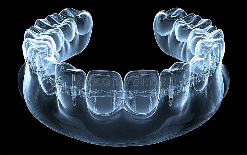 Detailed 3D Rendering of Clear Dental Aligners Showcasing Teeth ...