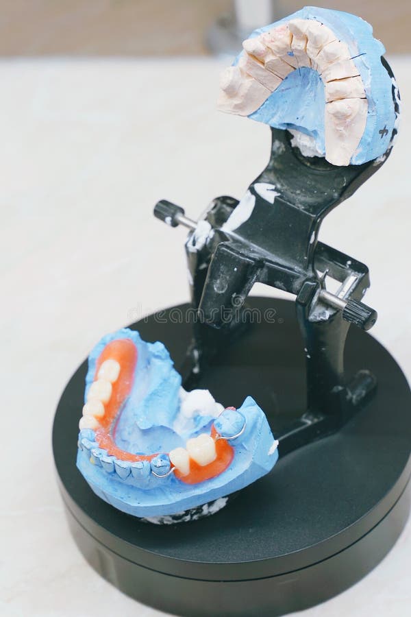 Detailed Dental Denture Model Showcasing Craftsmanship and Precision ...
