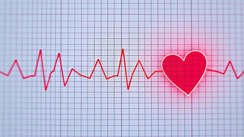 Analyzing a Heart Attack ECG Cardiogram Interpretation Heart Rate ...