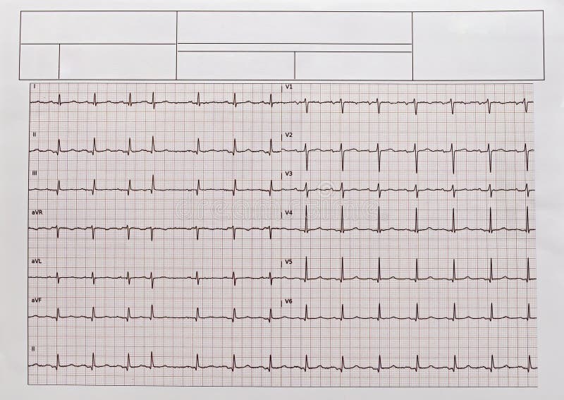 Detailed EKG, ECG, Electrocardiogram Showing Heartbeat Patterns. Stock ...