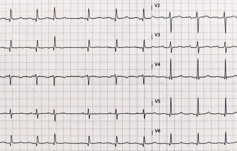 Detailed EKG, Electrocardiogram Showing Heartbeat Patterns. Stock Photo ...