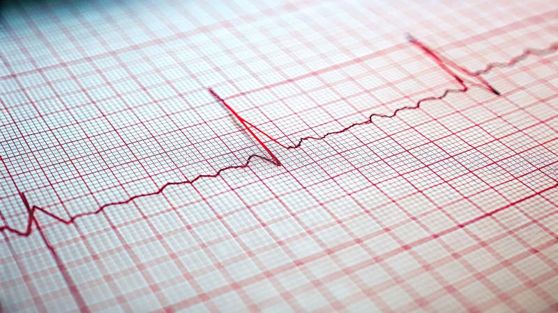 Detailed ECG Strip Analyzing Heart Rate and Rhythm for Accurate ...