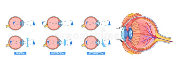 Explaining Myopia Stock Illustrations – 1 Explaining Myopia Stock ...