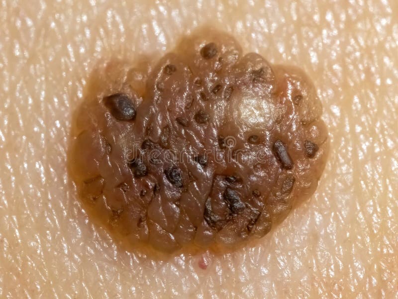 A Detailed Macro View of a Mole with Potential Indications of Malignant ...