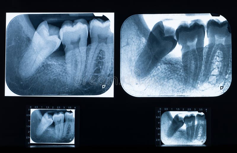 Detailed X-ray Scan with Impacted Wisdom Teeth Issue Stock Image ...