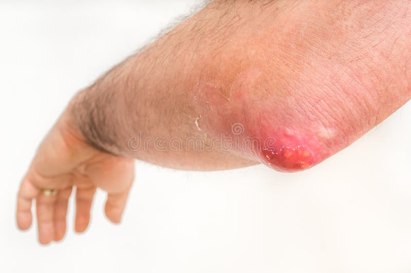 Detailed View Of Elbow With Carbuncle Or Furuncle Stock Image - Image ...