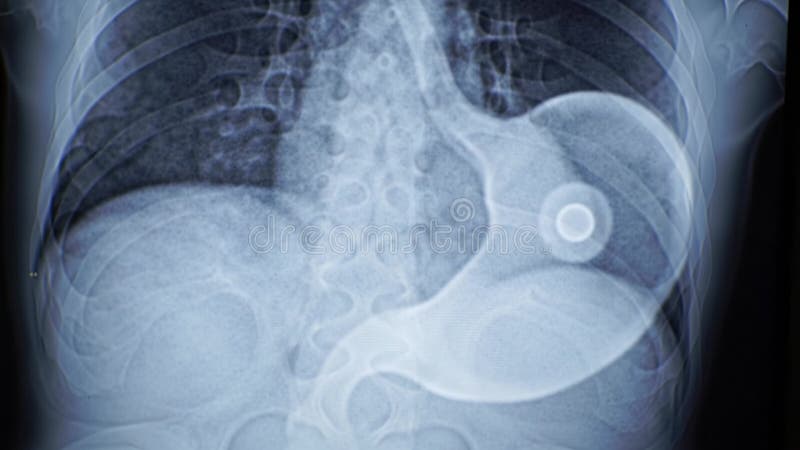 X-ray Showing Human Stomach and Esophagus with Air Bubble in the ...
