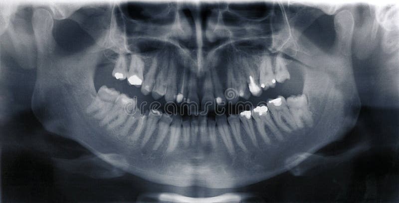 X-ray scan of human teeth stock photo. Image of mouth - 30110344