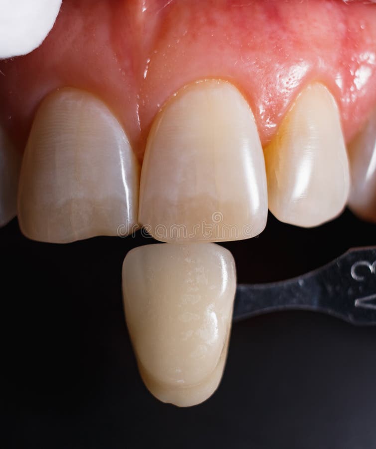 Determination of Tooth Color Using a Sample on a Black Background ...