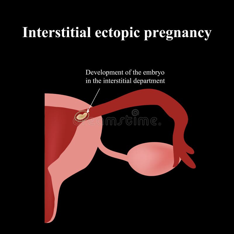 Development of the Embryo in the Interstitial Department. Ectopic ...
