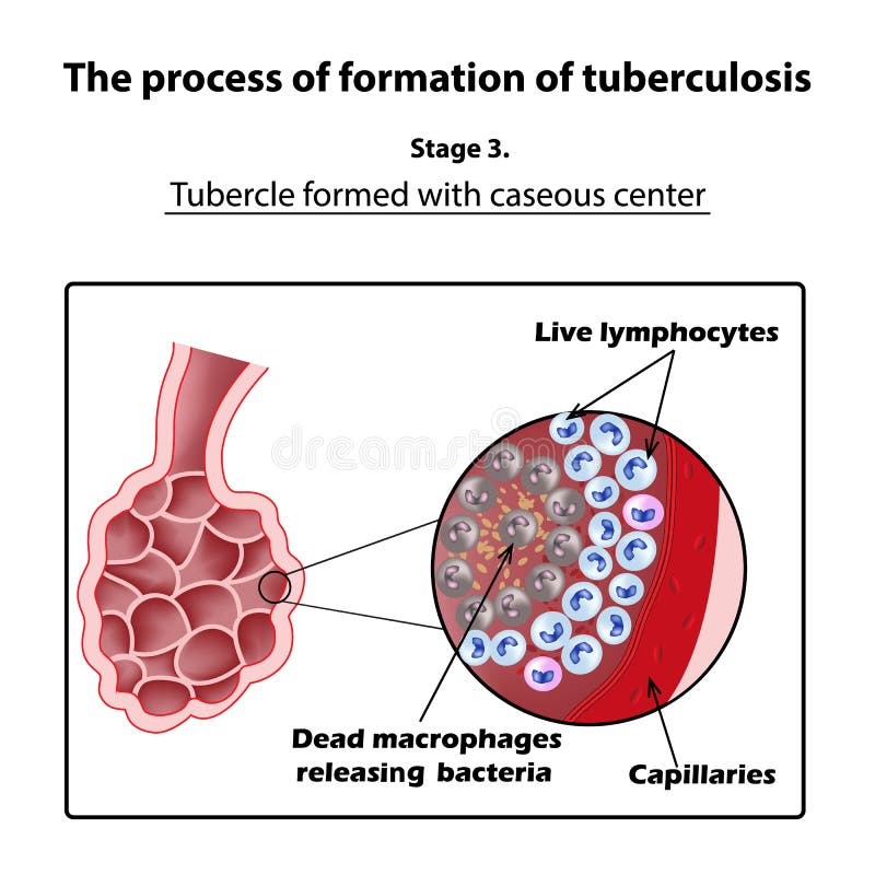 The Development of Tuberculosis. Stage 3. Infographics Stock Vector ...