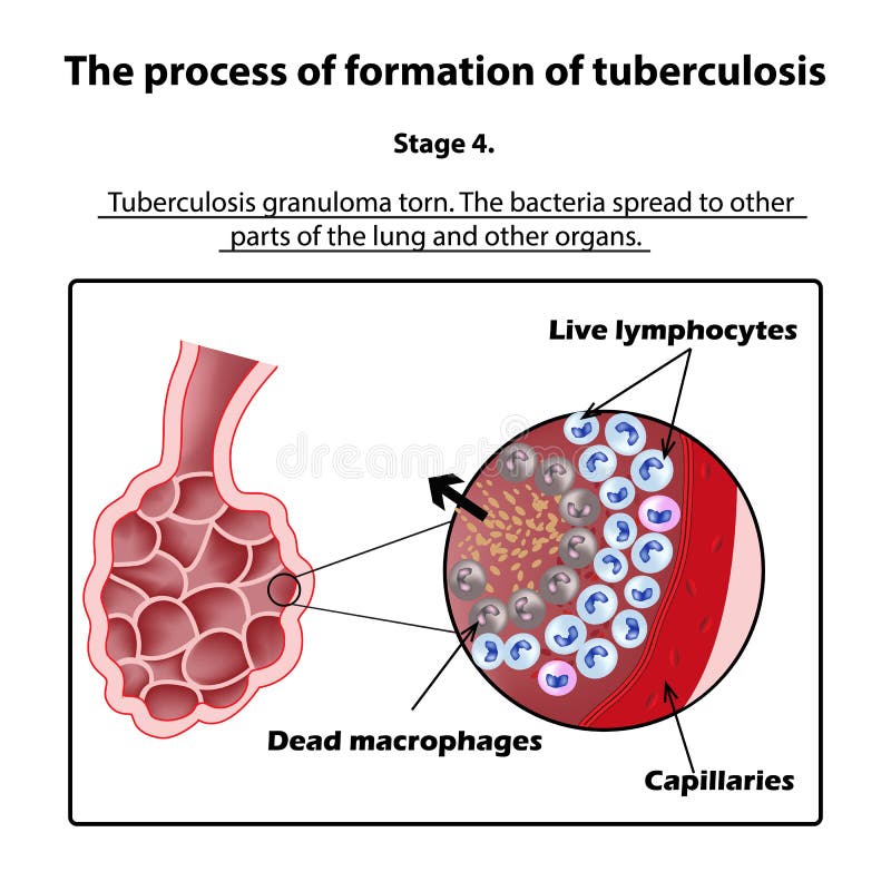 The Development of Tuberculosis. Stage 4. Infographics Stock Vector ...