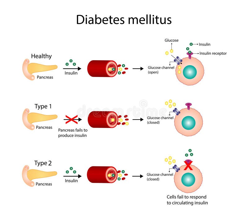 Insulin Resistance Stock Illustrations – 257 Insulin Resistance Stock ...