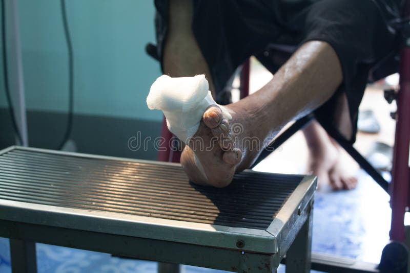 Diabetes ulcers stock photo. Image of illness, left - 103303524