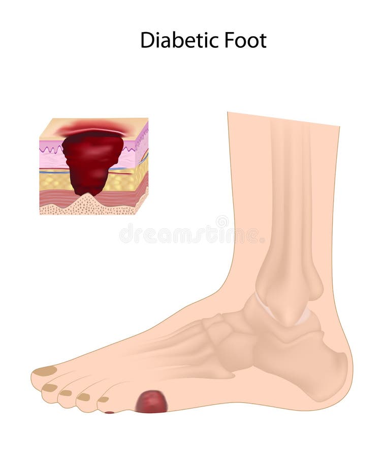 Diabetes voet vector illustratie. Illustration of zweren - 22431351