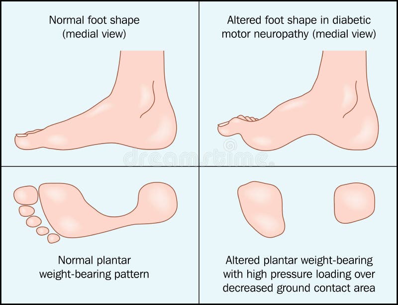 Diabetes voet vector illustratie. Illustration of zweren - 22431351