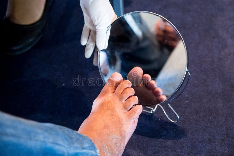 Diabetesvoet redactionele stock foto. Afbeelding bestaande uit wond ...