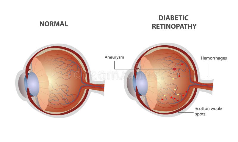 Diabetic Retinopathy, Eye, Vector Medical Illustration with Symbols ... Diabetic Retinopathy, Eye, Vector Medical Illustration with Symbols ...