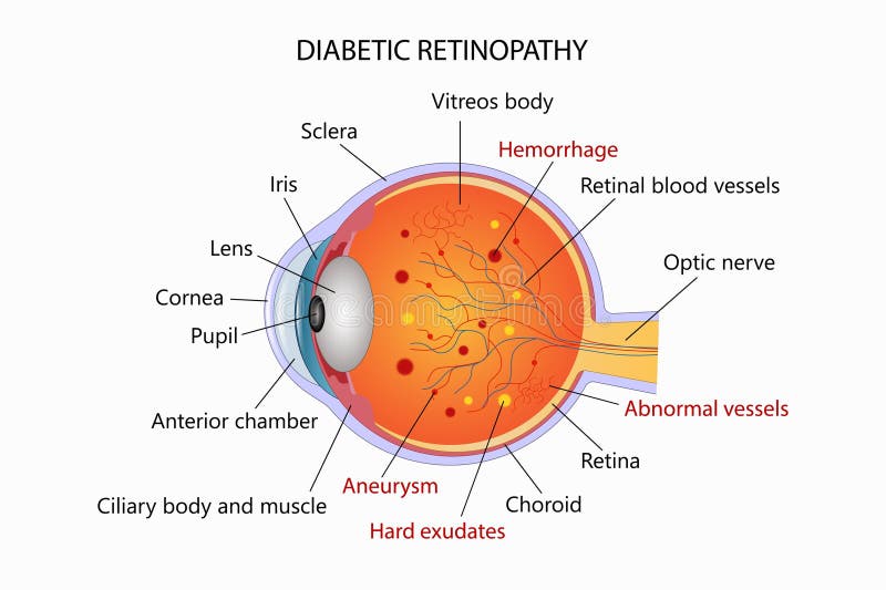 Diabetic Retinopathy Image, Medical Infographic. Stock Vector ...