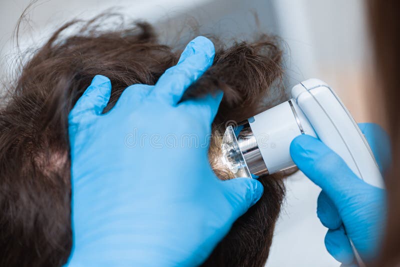 Trichoscopy of Hair and Scalp Closeup. Trichoscope in the Hands of a ...