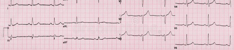 Curved Electrocardiogram Line Stock Illustration - Illustration of ...