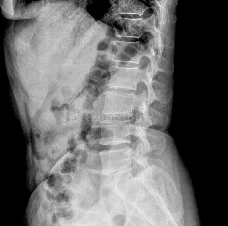 Diagnostic Spinal X-ray Film of a Patient Stock Photo - Image of pelvic ...