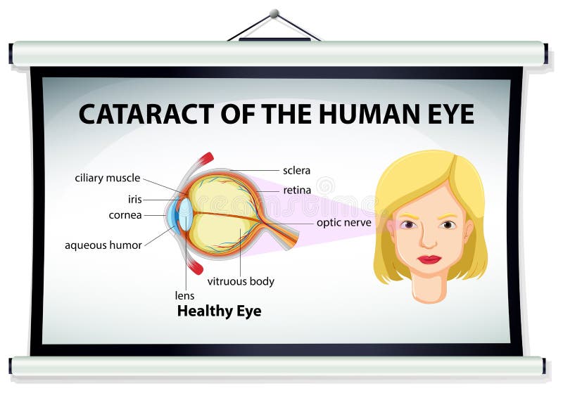 Diagram of Cataract in Human Eye Stock Vector - Illustration of clip ...