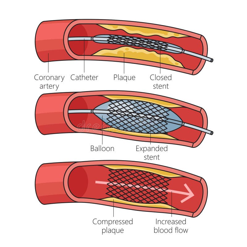 Diagram Coronary Stent Placement Medical Science Stock Illustration ...