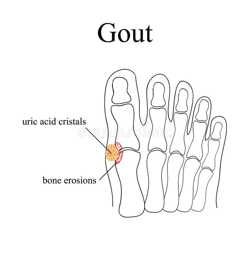 Gout in Human Hand Vector / Human, Anatomy Stock Vector - Illustration ...