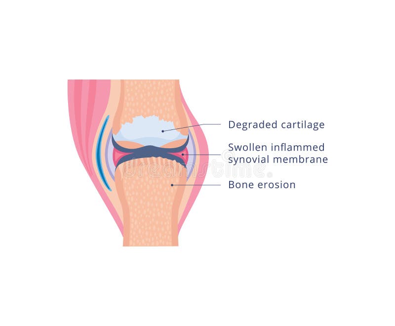 Diagram Of Knee Joint With Osteoarthritis Flat Vector Illustration