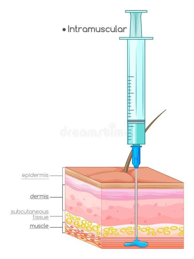 Intramuscular Injection and Subcutaneous Injection Stock Vector ...