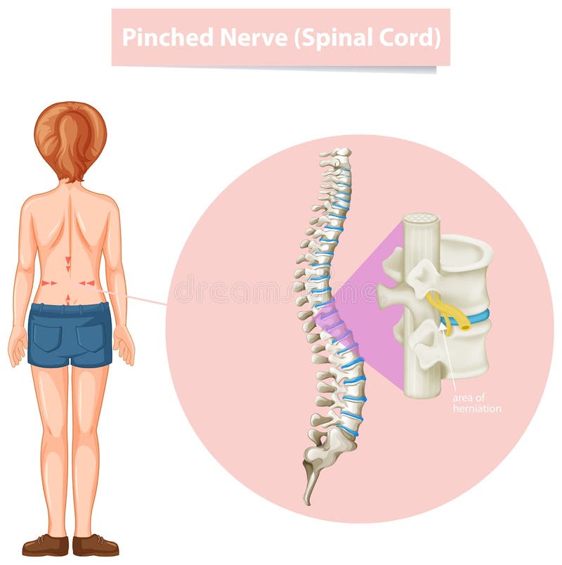 Diagram Showing Pinched Nerve Stock Vector - Illustration of lady, cord ... Diagram Showing Pinched Nerve Stock Vector - Illustration of lady, cord ...