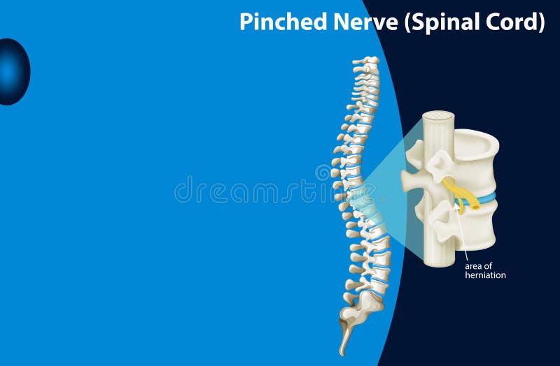 Pinched spinal nerve model stock illustration. Illustration of hernia ...