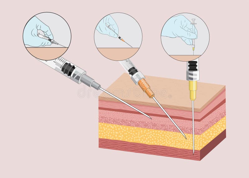 Injection Diagram Stock Illustrations – 1,078 Injection Diagram Stock ...