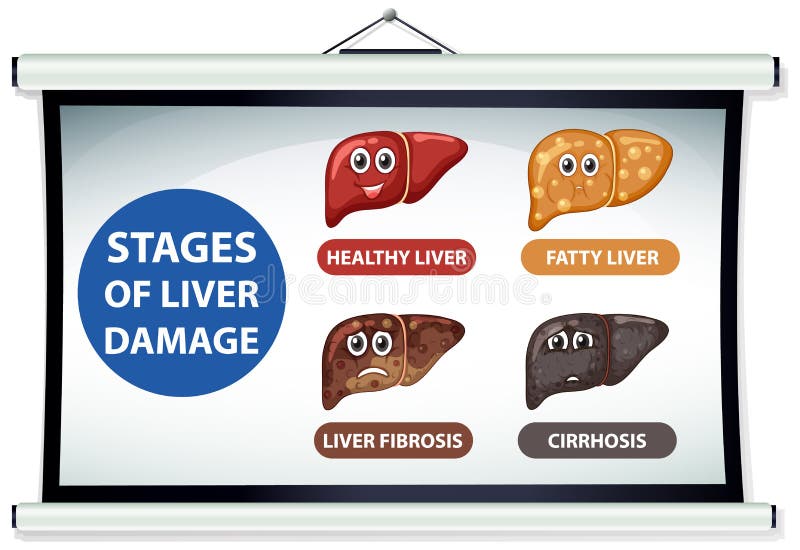 Diagram Showing Stages of Liver Damage Stock Vector - Illustration of ... Diagram Showing Stages of Liver Damage Stock Vector - Illustration of ...