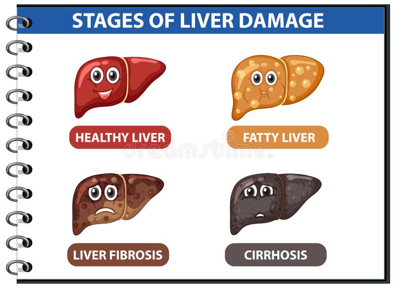 Diagram Showing Stages of Liver Damage Stock Vector - Illustration of ... Diagram Showing Stages of Liver Damage Stock Vector - Illustration of ...