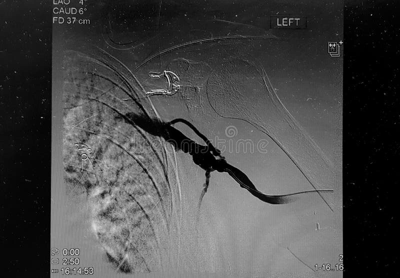 Arm with dialysis shunt stock photo. Image of renal, kidney - 383570