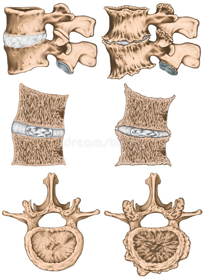 Advanced Uncovertebral Arthrosis Stock Photo - Image of physical ...