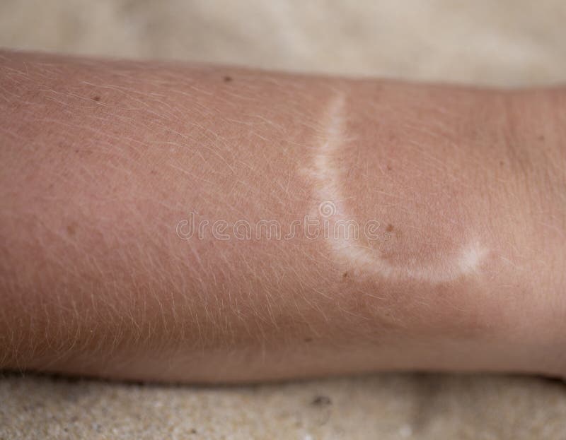 Die Hand mit der Narbe stockfoto. Bild von oberfläche - 170800680