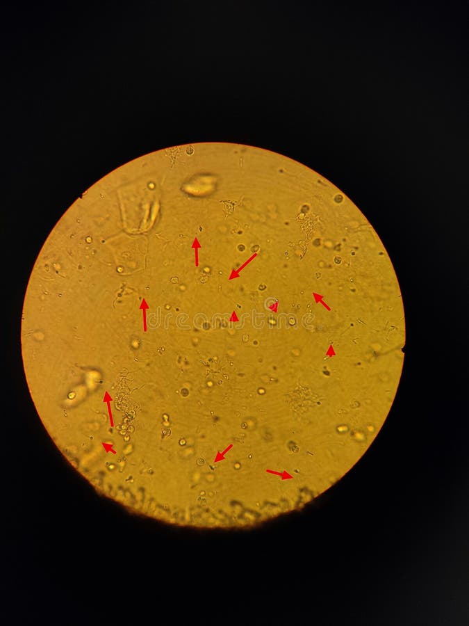 Die Urinprobe Unter Dem Mikroskop Stockfoto - Bild von leukozyte, labor ...