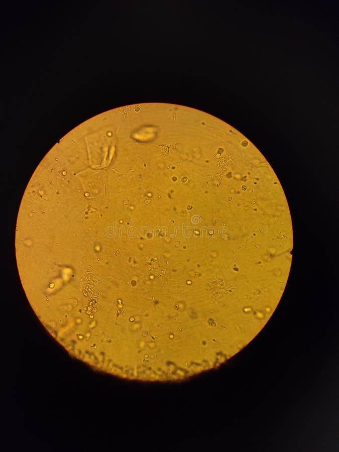 Die Urinprobe Unter Dem Mikroskop Stockbild - Bild von samen, leukozyte ...