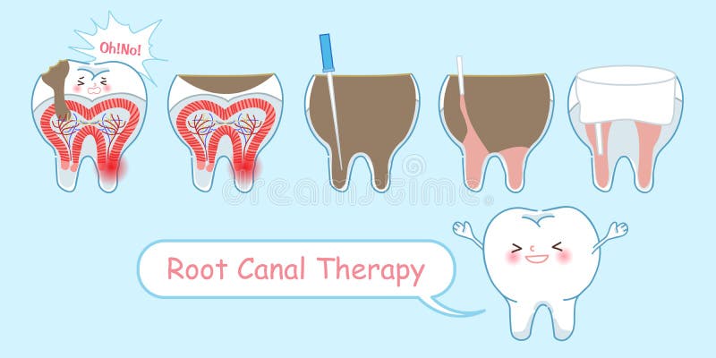Diente Con El Tratamiento De La Endodoncia Ilustración del Vector ...