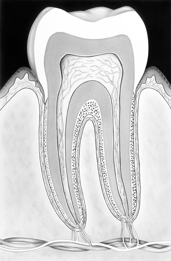 Diente Con Terapia De La Endodoncia Ilustración del Vector ...