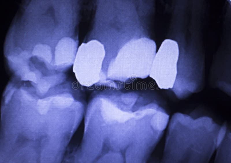 Diente Que Llena La Radiografía Dental Imagen de archivo - Imagen de ...