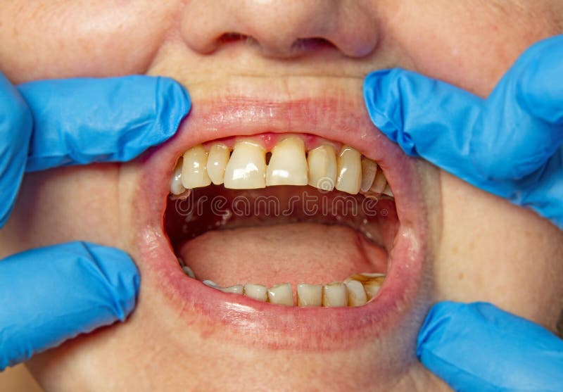 Dientes con periodontitis foto de archivo. Imagen de oral - 139459378