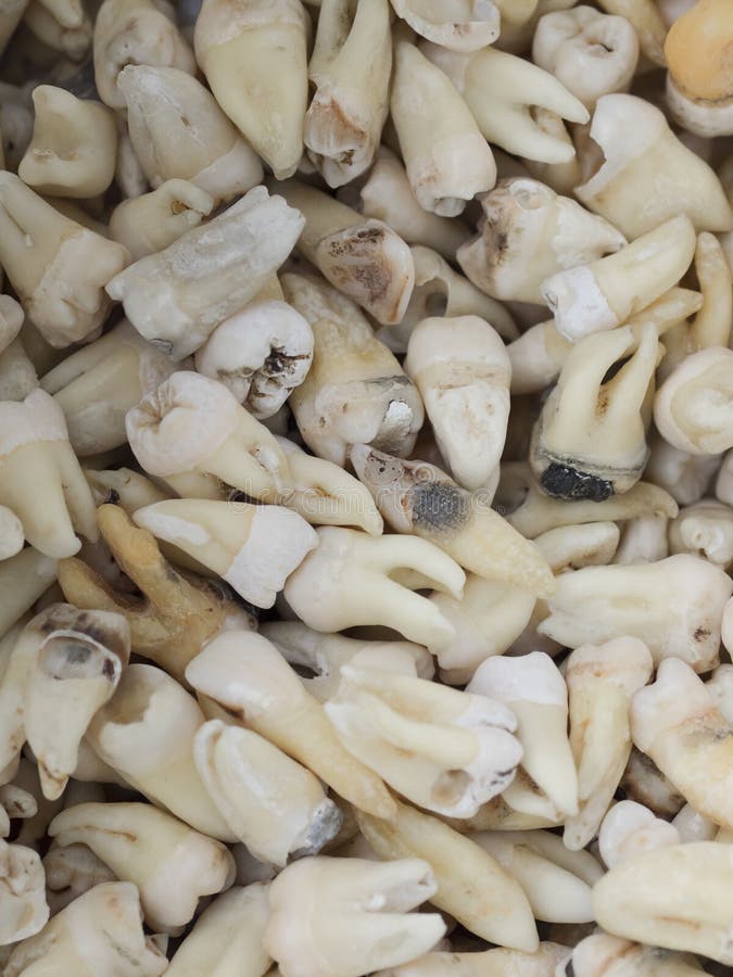 Dientes Extraídos Con Diversos Defectos Foto de archivo - Imagen de ...